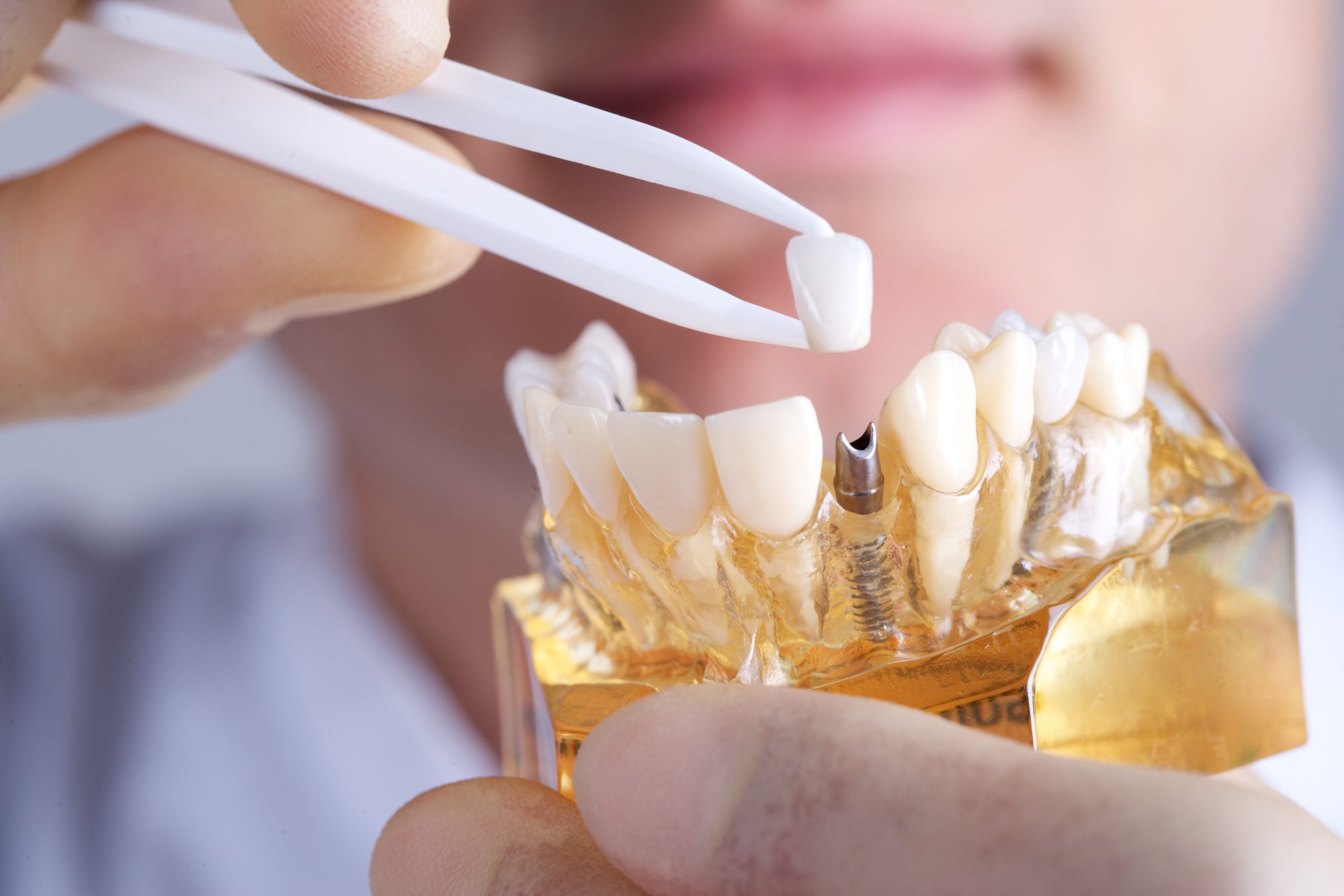 How To Care For Your Dental Implants - Harmony Dental Care