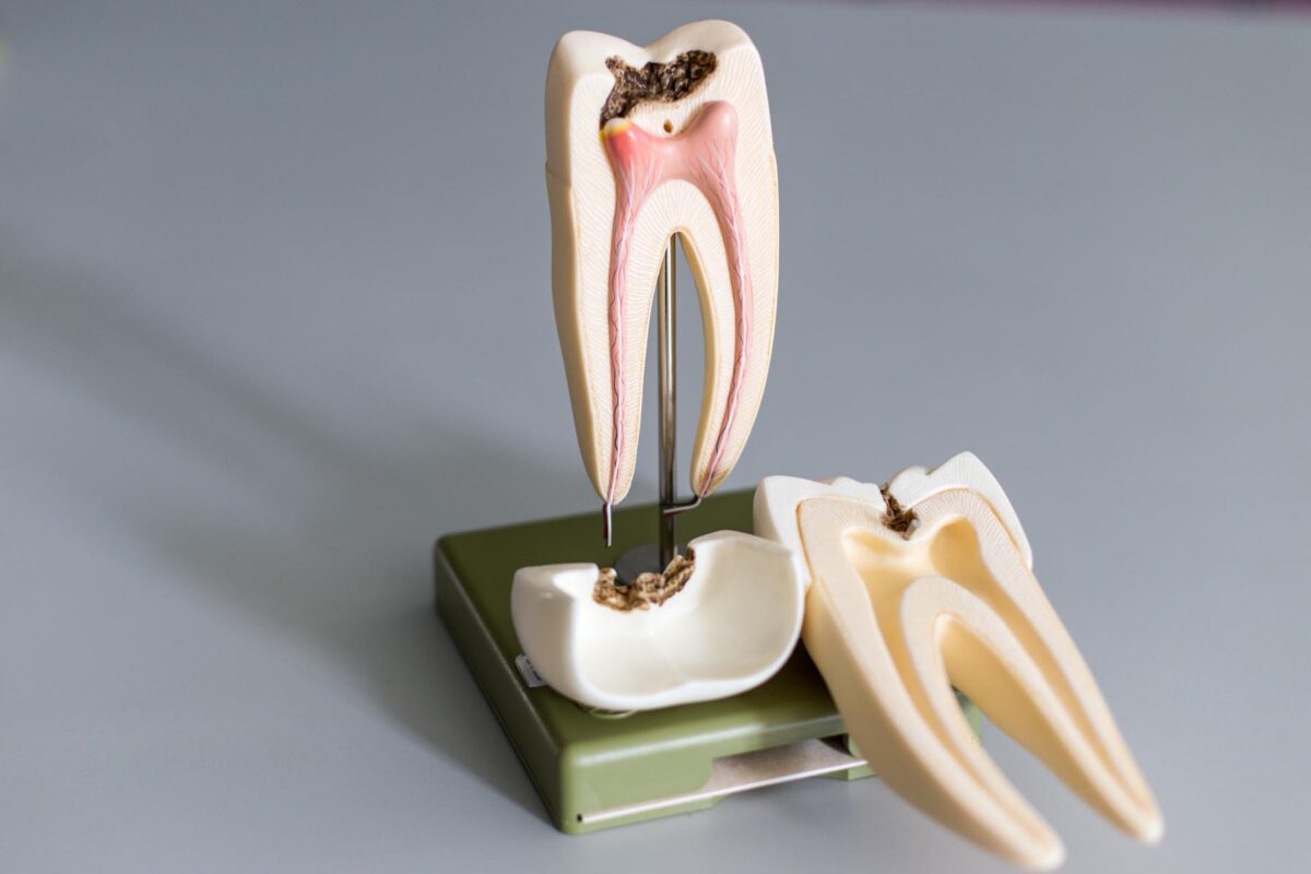 Can I Lose My Tooth Without a Root Canal?